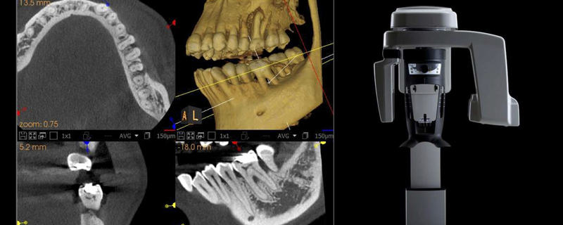 Tomografia CBCT – najnowsza jakość zdjęć 3D RTG w stomatologii ...