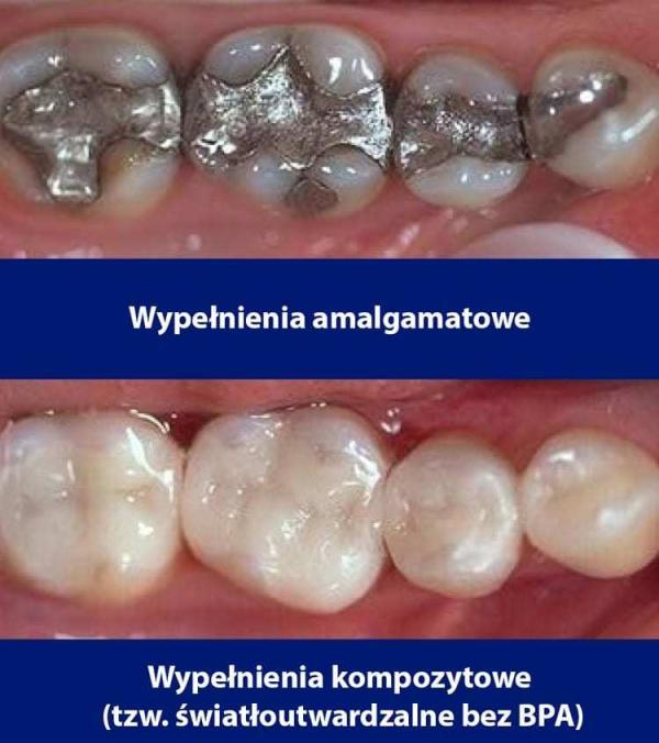 Bezpieczne usuwanie amalgamatów metodą SMART - Dentysta.eu - Marcin ...