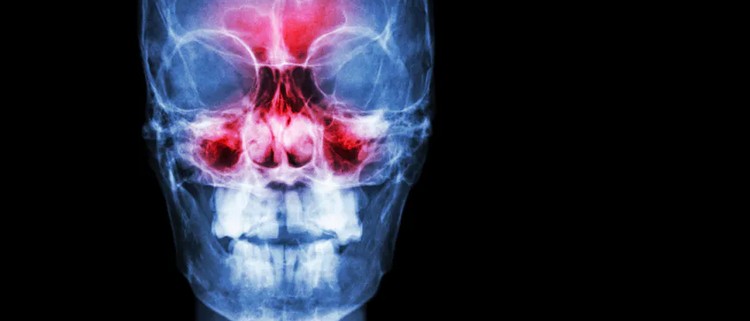 Operacja zatoki szczękowej metodą Caldwella-Luca - Dentysta.eu - Marcin ...